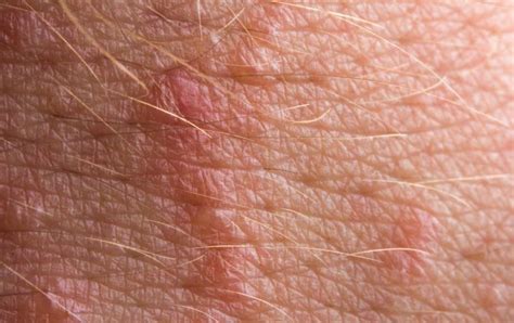 Poison Ivy Rash Peak At Sophia Iliffe Blog
