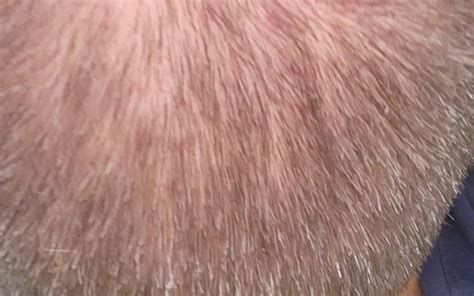 Seb Derm Scalp R Dermatologyquestions