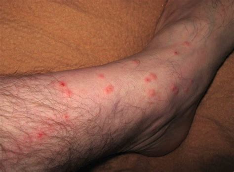 Top 10 Gnat Bites Pictures Explained Y L P C