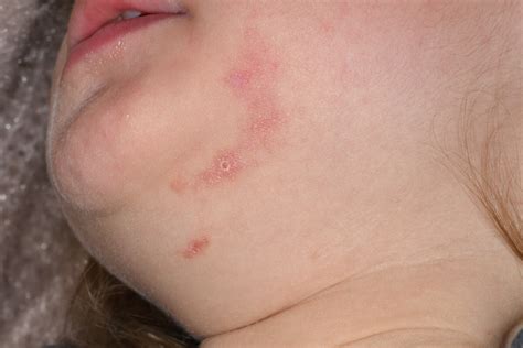 Speediatrics Can You Solve This Case Featuring A Linear Rash Pulse Speediatrics Can You Solve This Case Featuring A Linear Rash Pulse