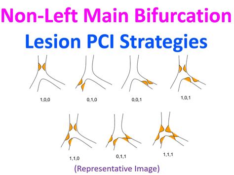 Non Left Main Bifurcation Lesion Pci Strategies All About Cardiovascular System And Disorders
