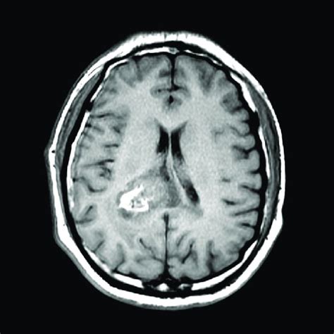 Mri Brain T2 Weighted Axial Gradient Echo Sequences Gre Image