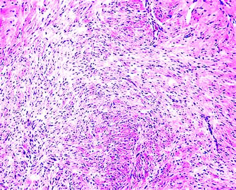 Pathology Outlines Neurofibroma General