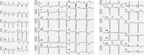Twelve Lead Electrocardiograms Left Typical Atrial Flutter And 21 Download Scientific