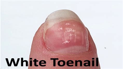 Toenail Problems