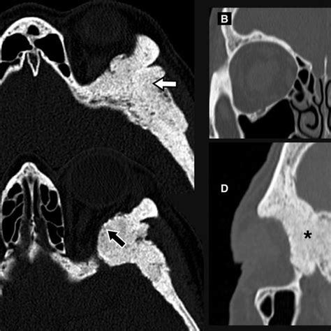 56 Yo Presenting With Left Frontal Bone Hyperostosis White Arrow Download Scientific Diagram