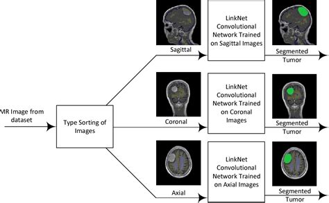 Figure 3 From Brain Tumor Segmentation Using Deep Learning By Type Specific Sorting Of Images