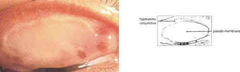 The Conjunctiva Diseases And Tumours Ento Key