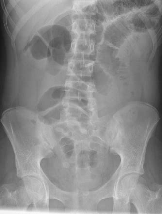 Perforated Appendicitis With Pelvic Abscess Radiology Case Radiopaedia Org