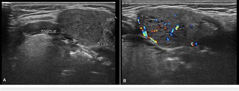 Ultrasound Usg Of The Left Submandibular Region Shows A Well Defined Download Scientific