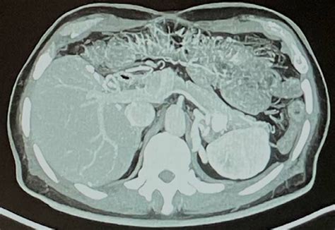 computed tomography image at 2 y after ldlt showed good patency of the download scientific