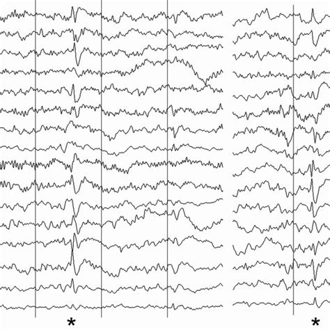 Abnormal Generalized Sharp Waves Download Scientific Diagram