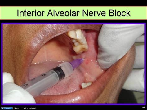 Gemc Dental Emergencies And Common Dental Blocks Resident Training