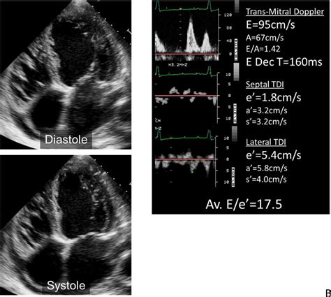 Figure 1 From Role Of Diastolic Function In Preserved Exercise Capacity