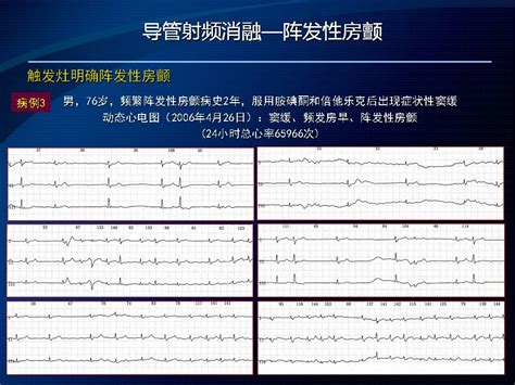 心房颤动的个体化导管消融 适应症与消融策略 严道医声网