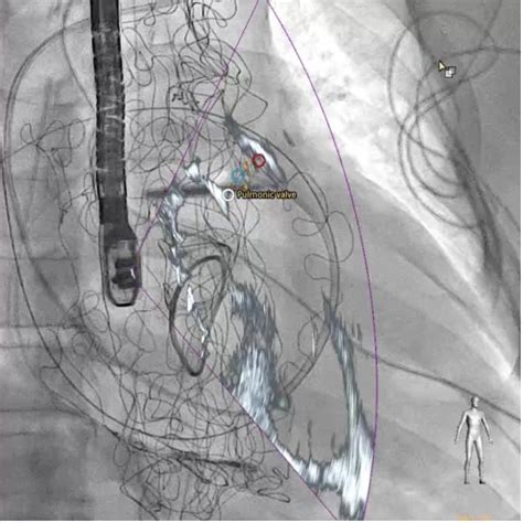 Echo Navigator Facilitated Placement Of A Percutaneous Right Ventricular Assist Device In