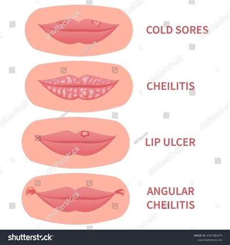 Angular Cheilitis Vs Cold Sore Home Remedies For Angular Cheilitis ~ Angular Cheilitis