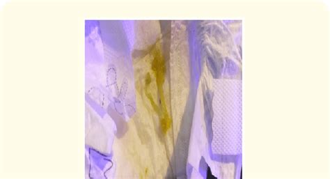 Thick Inspissated Mucoid Material Meconium Plug Download Scientific