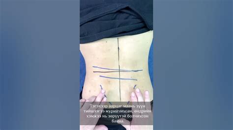 Аарцгийн гажилт гэж юу вэ Youtube