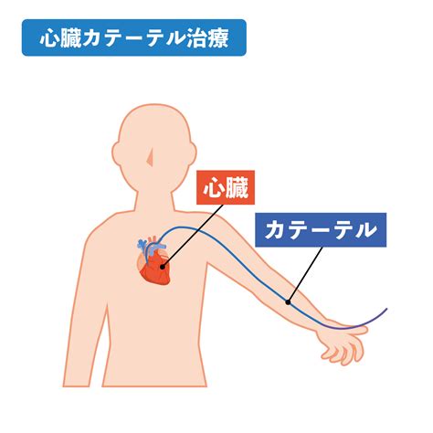 狭心症の身体に負担の少ないカテーテル治療・経皮的冠動脈形成術（pci） 音羽デイサービス 友