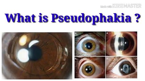 What Is Pseudophakia Sign Intraocular Lens Sharp Vision Youtube