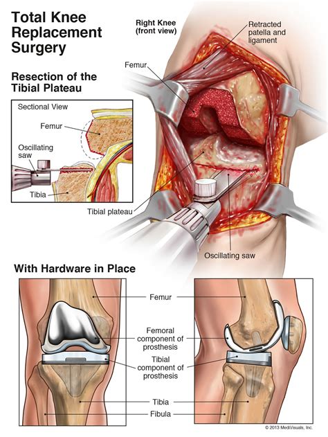 Total Knee Replacement Anatomy