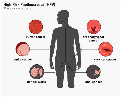 Life Saving Vaccine To Prevent Cervical Cancer