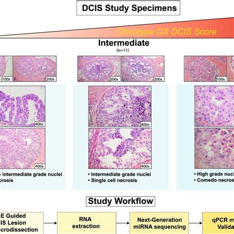 Dcis Sample Distribution Across The Three Oncotype Dx® Dcis Risk Groups