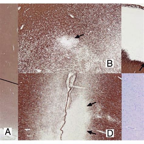 Post Mortem Mri And Accompanying Plp Immunohistochemical Staining Of A