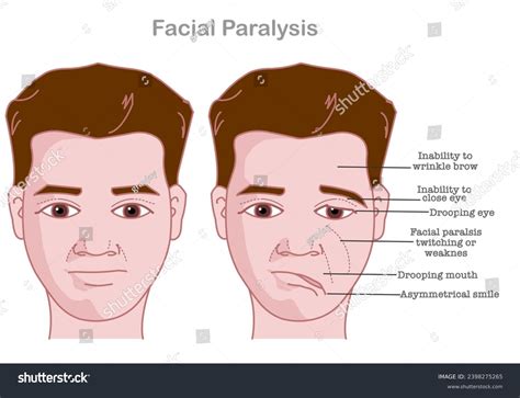 Facial Paralysis Bell Palsy Drooping Eyes Stock Vector Royalty Free 2398275265 Shutterstock