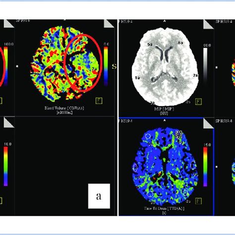 Ct Perfusion Mip Cbf Cbv Ttd Mtt Maps A Preoperative Data The Download Scientific