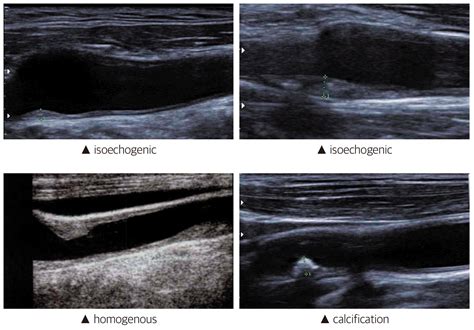 경동맥 초음파 Carotid Ultrasonography Metamedic