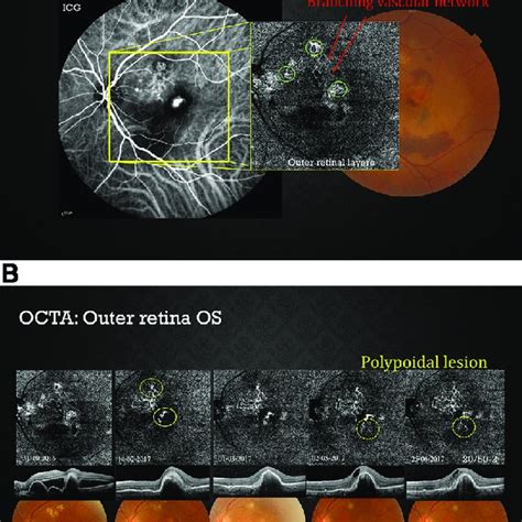 Bevacizumab And Ranibizumab For Pcv Visual Acuity Optical Coherence Download Scientific