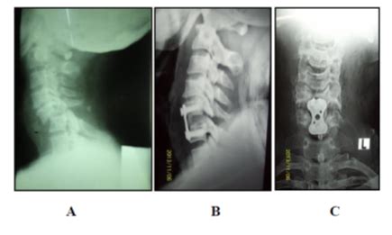 An Innovative Technique For Anterior Cervical Surgery In Sub Axial Cervical Fracture Dislocation