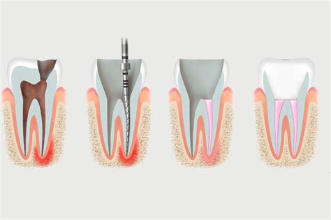 Материал для перекрытия пульпы фото