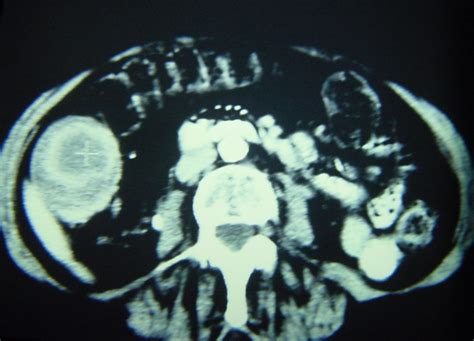 Gall Bladder Neoplasm 2555 Gall Bladder Neoplasm Papillary Carcinoma