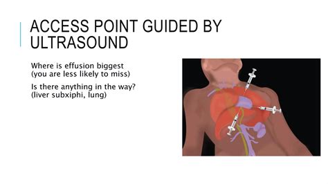 Pericardiocentesis Procedurepptx