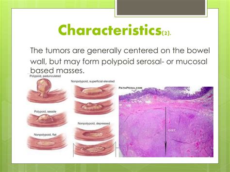 Ppt Gists Gastrointestinal Stromal Tumor Powerpoint Presentation Free Download Id 6407506