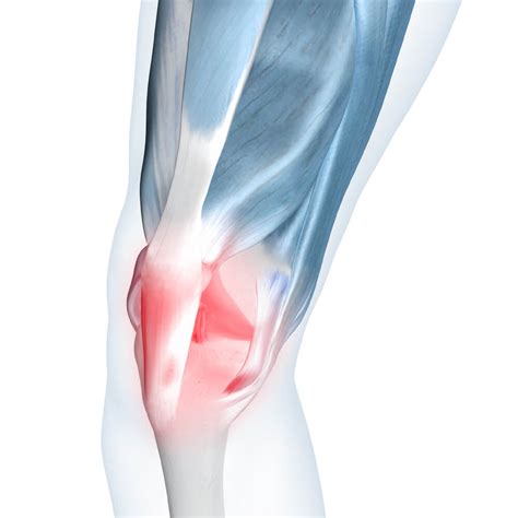 Patellar Tendonitis Symptoms Causes And Treatment Options Knee