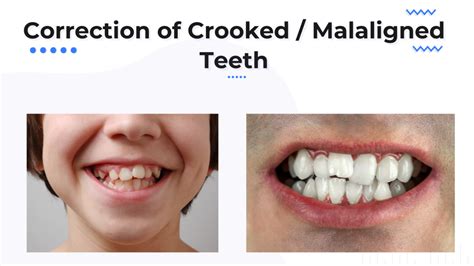 Crooked Teeth With Braces