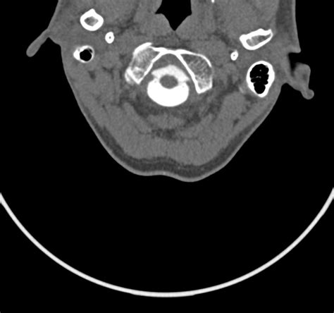 Cervical Dural Csf Leak On Mri And Ct Treated By Blood Patch