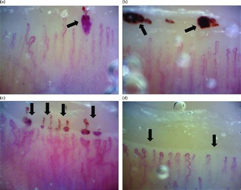 Nailfold Capillaroscopy Abnormalities Found In Patient With Acute