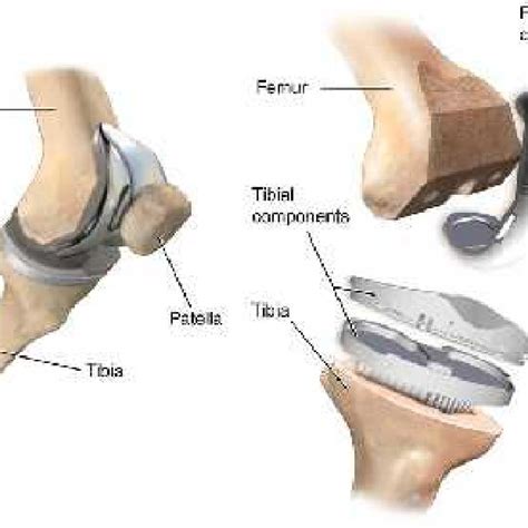 The Dimensions Of The Initial Tibial Components Figure 5 The Loading