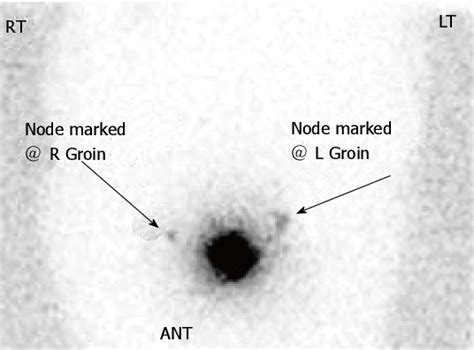 Sentinel Lymph Node Mapping Of A Breast Cancer Of The Vulva Case Report And Literature Review