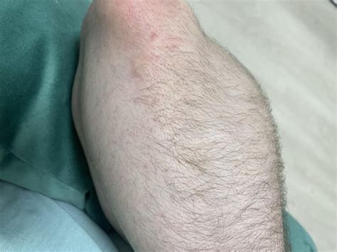 Something Strange R Urticaria