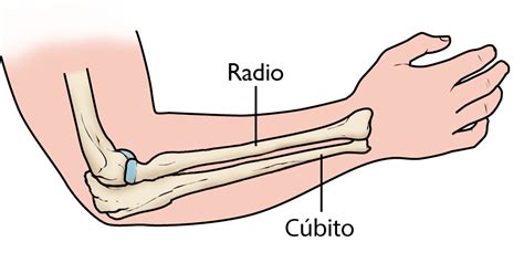 Fracturas Distales Del Radio Muñeca Quebrada Distal Radius Fractures