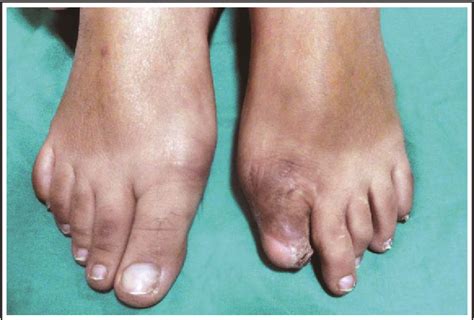 Figure 2 From Prosthetic Rehabilitation Of Amputated Hallux After