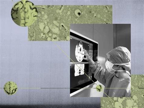 Prion Disease Definition Symptoms Treatment And More