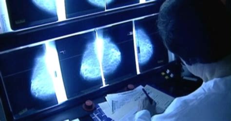 Ontario Lowers The Age For Self Referral Mammogram Breast Screening To Age 40
