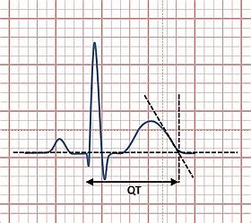 QT Interval Wikipedia